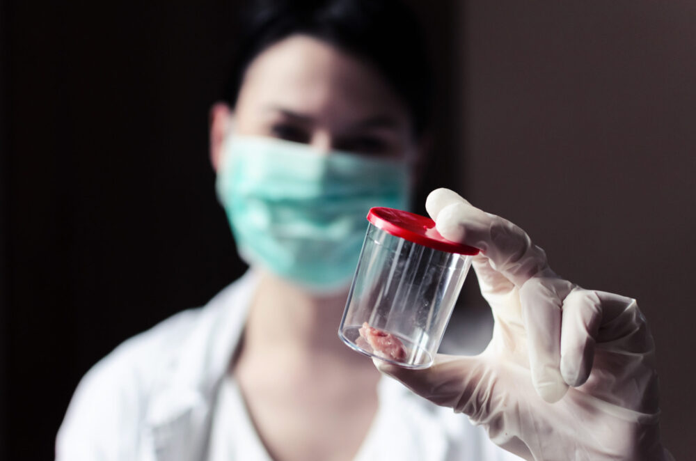 ¿Puede la biopsia líquida reemplazar a la biopsia de tejido ...